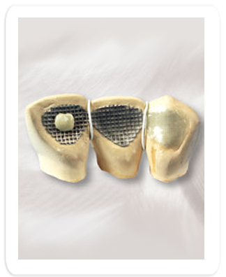 Perfect Splint System Combination Set - (10) Stainless Steel Nets, (10 ...